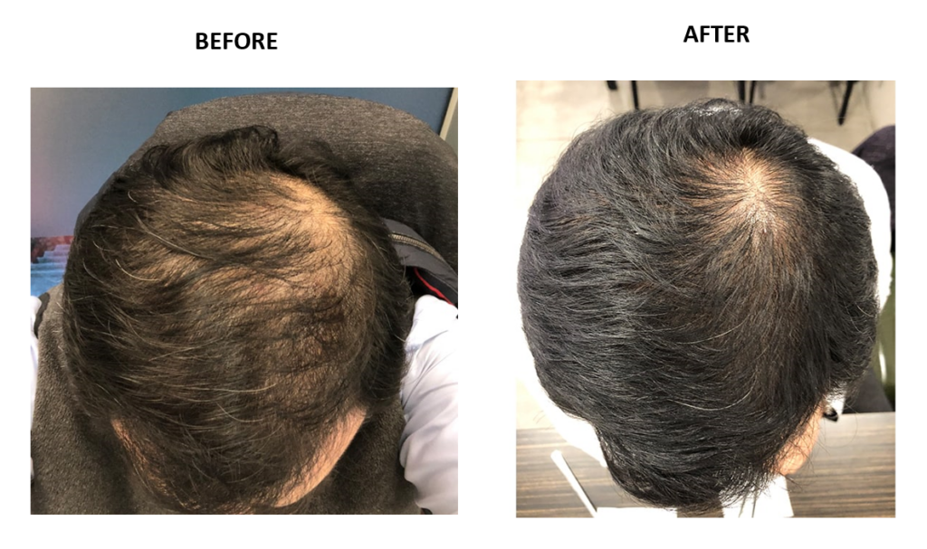 Stem Cell Therapy Scalp Hair Injection - Amoa 640